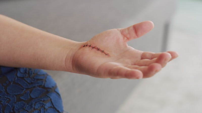 Stitches, Hand, Wound, Injury by Via Films – Stock Footage | Artlist